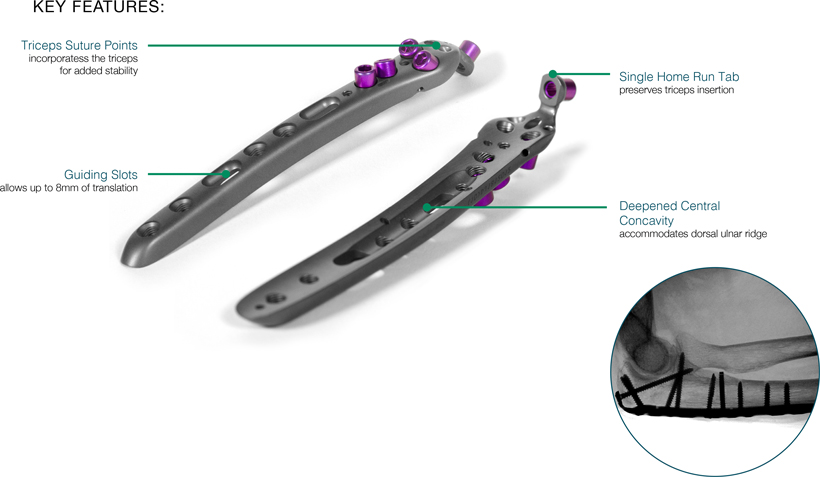 Proximal Ulna Plate - Skeletal Dynamics Skeletal Dynamics
