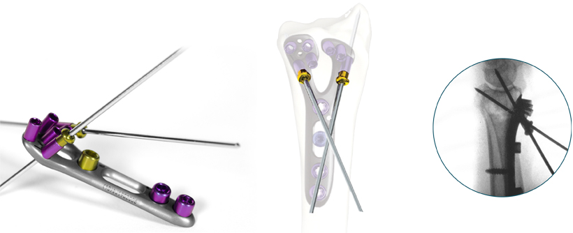 Geminus Volar Distal Radius Plate - Skeletal Dynamics Skeletal Dynamics