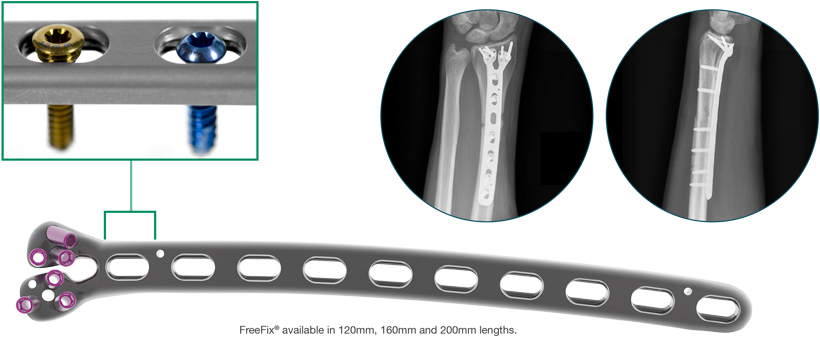 Geminus Volar Distal Radius Plate - Skeletal Dynamics Skeletal Dynamics