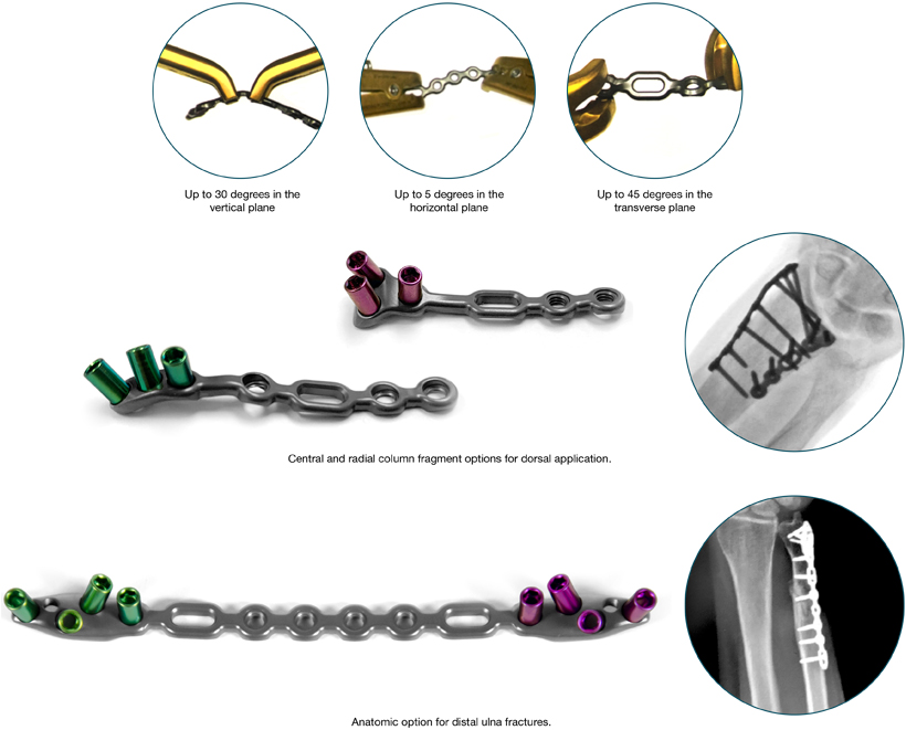 Protean Fragment Plates Wrist Skeletal Dynamics Skeletal Dynamics