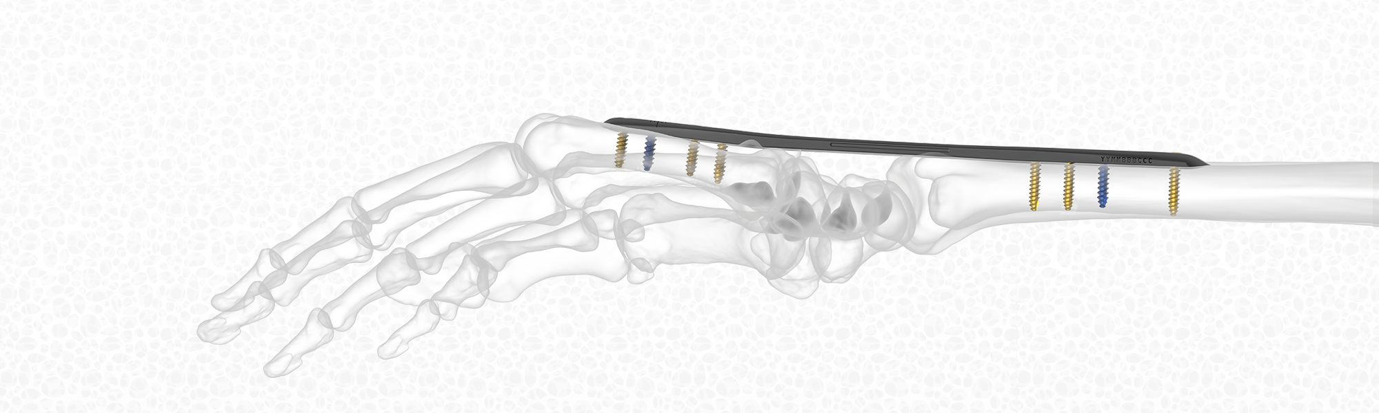 Dorsal Spanning Plate - Skeletal Dynamics Dorsal Spanning Plate - Skeletal Dynamics