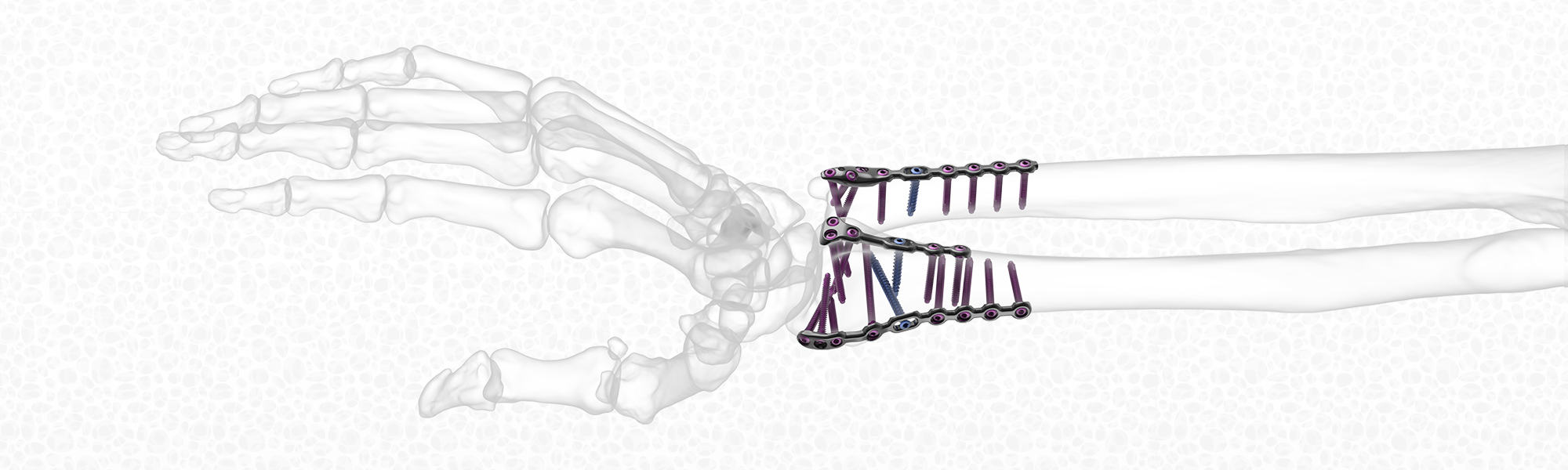 Protean® Fragment Plating System Skeletal Dynamics