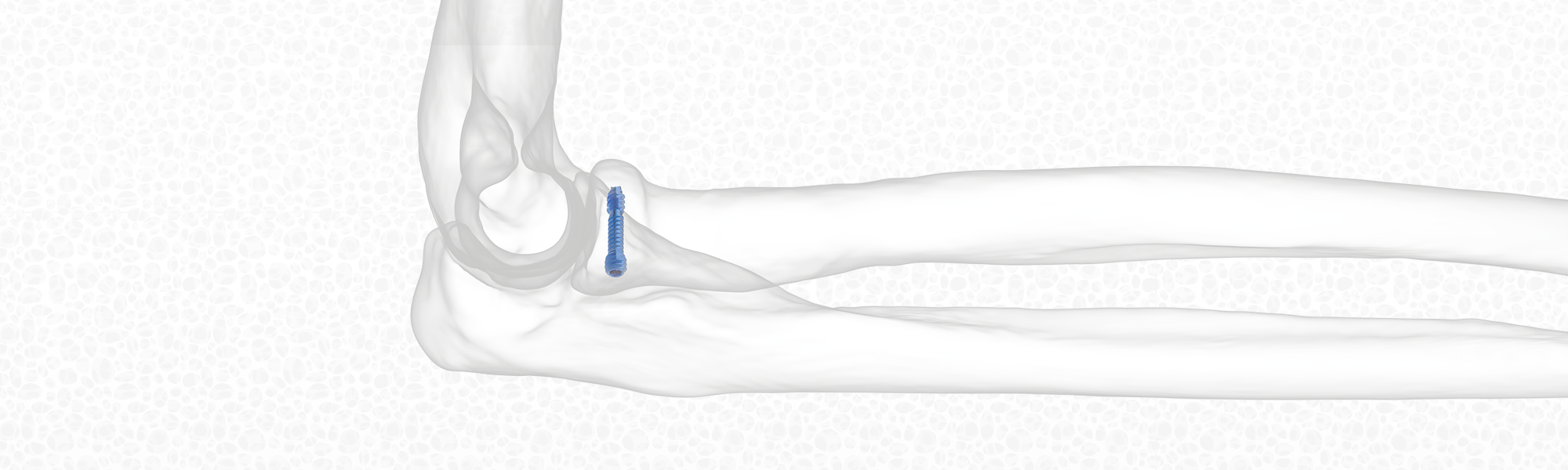Reduct® Headless Compression Screw Skeletal Dynamics