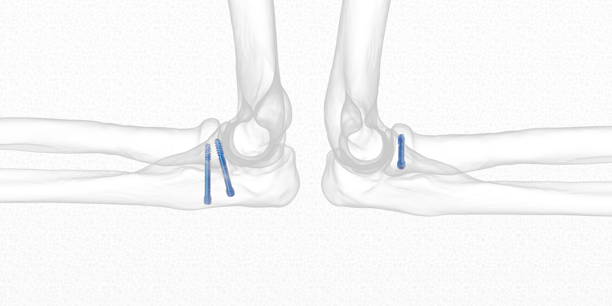 REDUCT® Headless Compression Screw (Elbow) - Skeletal Dynamics Skeletal ... REDUCT® Headless Compression Screw (Elbow) - Skeletal Dynamics Skeletal ...