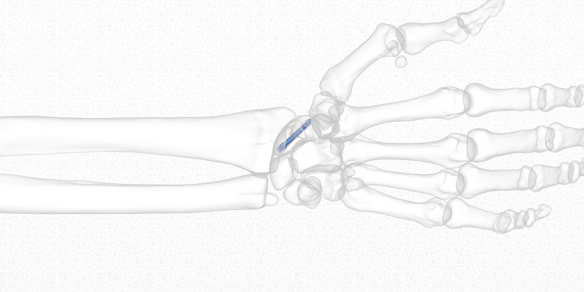 REDUCT® Headless Compression Screw - Skeletal Dynamics Skeletal Dynamics