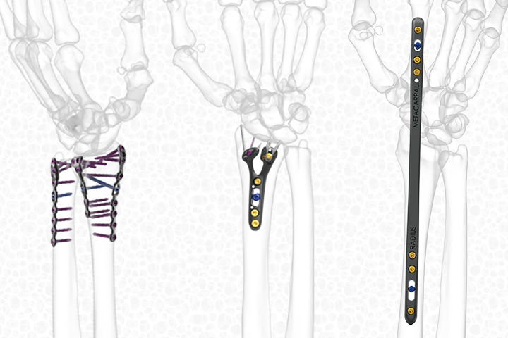 GEMINUS® DISTAL RADIUS SYSTEM - Skeletal Dynamics Skeletal Dynamics GEMINUS® DISTAL RADIUS SYSTEM - Skeletal Dynamics Skeletal Dynamics
