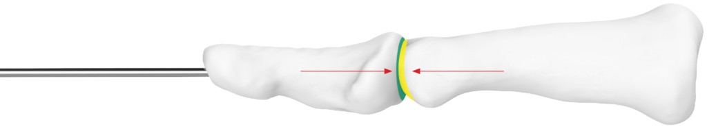 REDUCT® Arthrodesis Screw System - Skeletal Dynamics