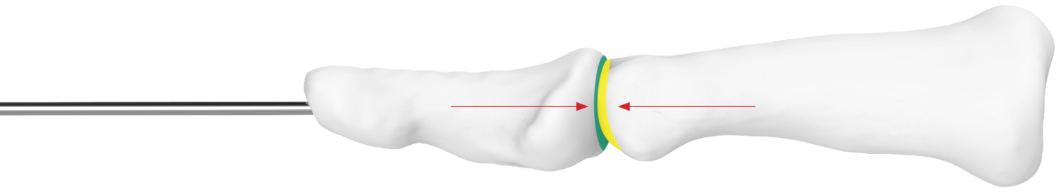 REDUCT® Arthrodesis Screw System - Skeletal Dynamics