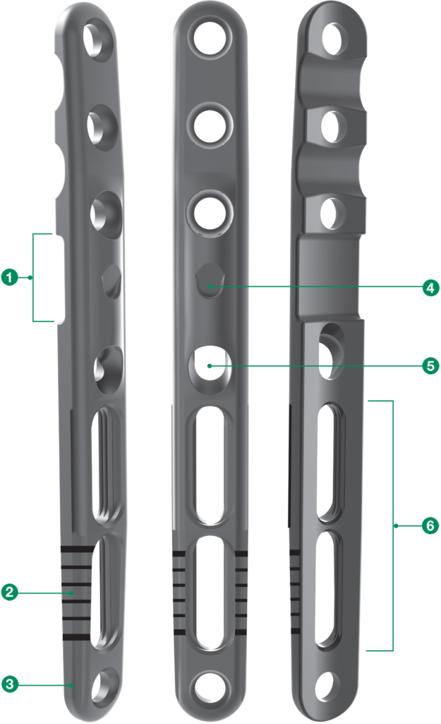 FREEFIX® Ulnar Shortening System - Skeletal Dynamics