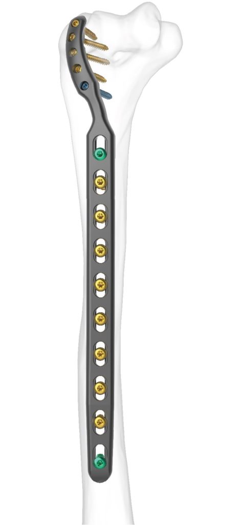 FREEFIX® Humeral Fixation Set - Skeletal Dynamics