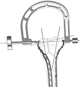 FREEFIX® Humeral Fixation Set - Skeletal Dynamics