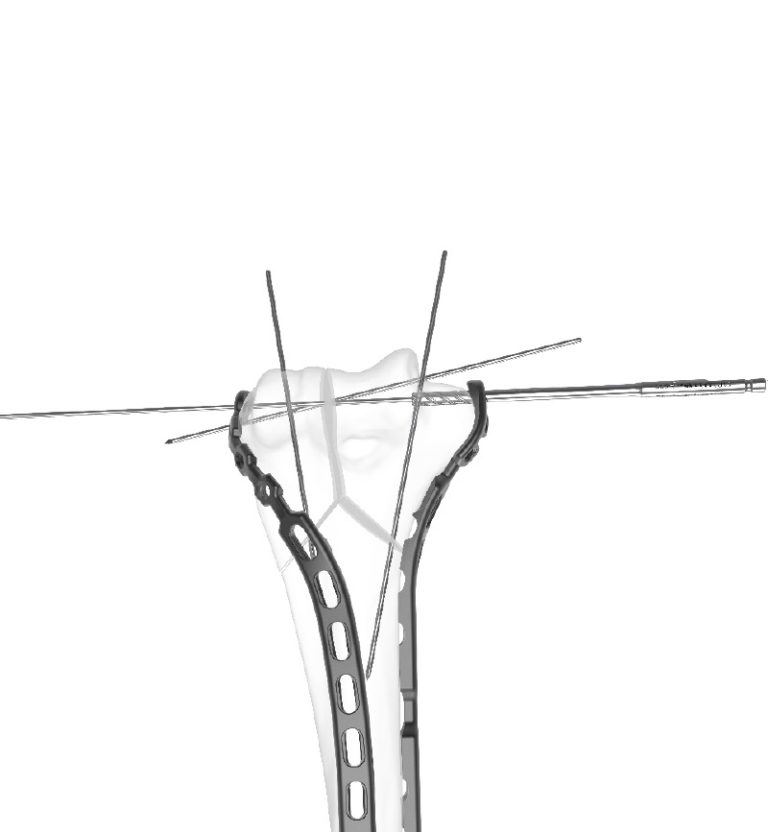 FREEFIX® Humeral Fixation Set - Skeletal Dynamics