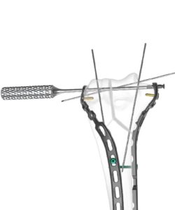 FREEFIX® Humeral Fixation Set - Skeletal Dynamics