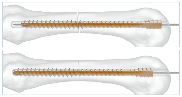 THREADED HAND NAIL - Skeletal Dynamics