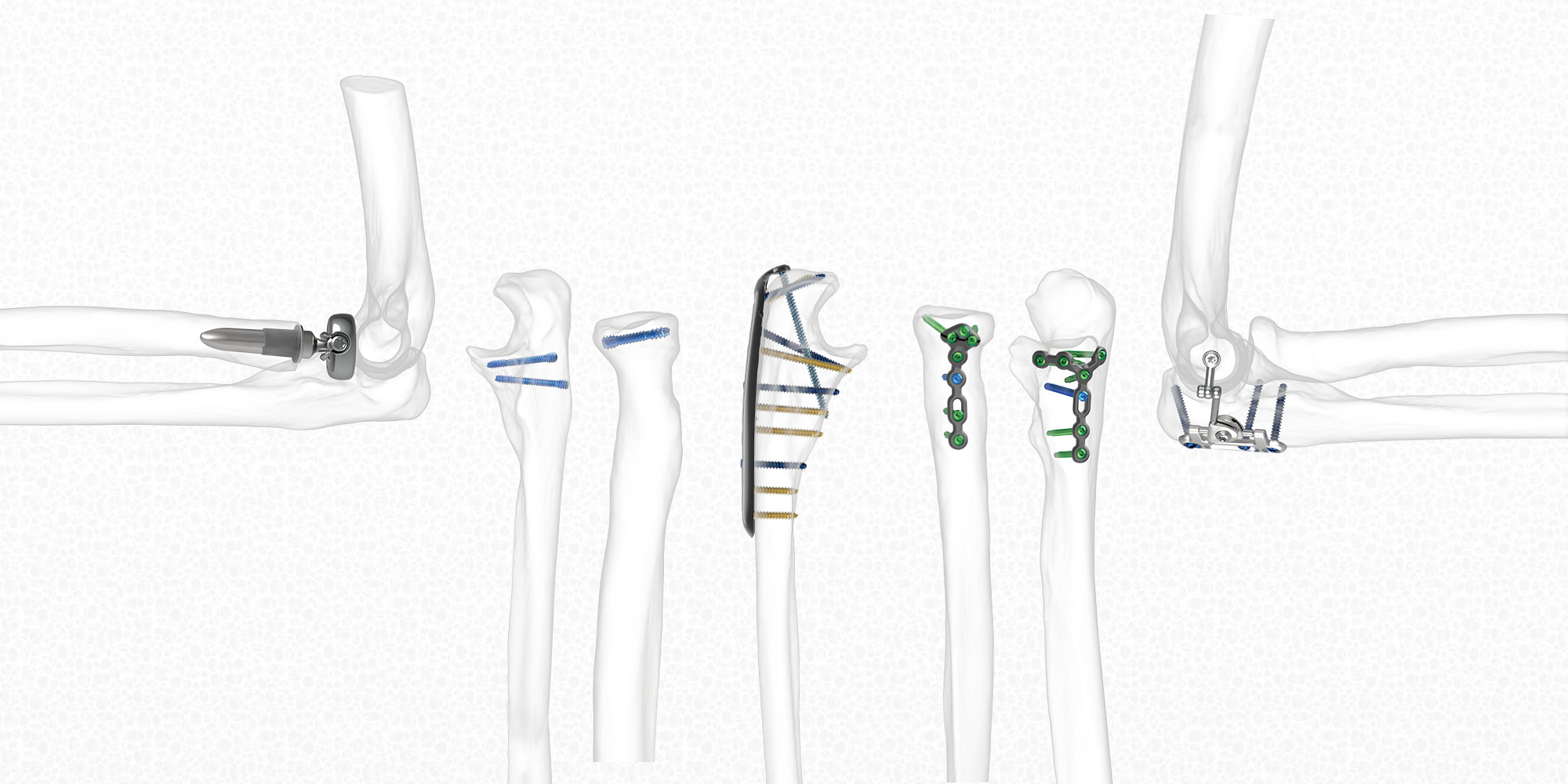DISTAL ELBOW SET - Skeletal Dynamics DISTAL ELBOW SET - Skeletal Dynamics