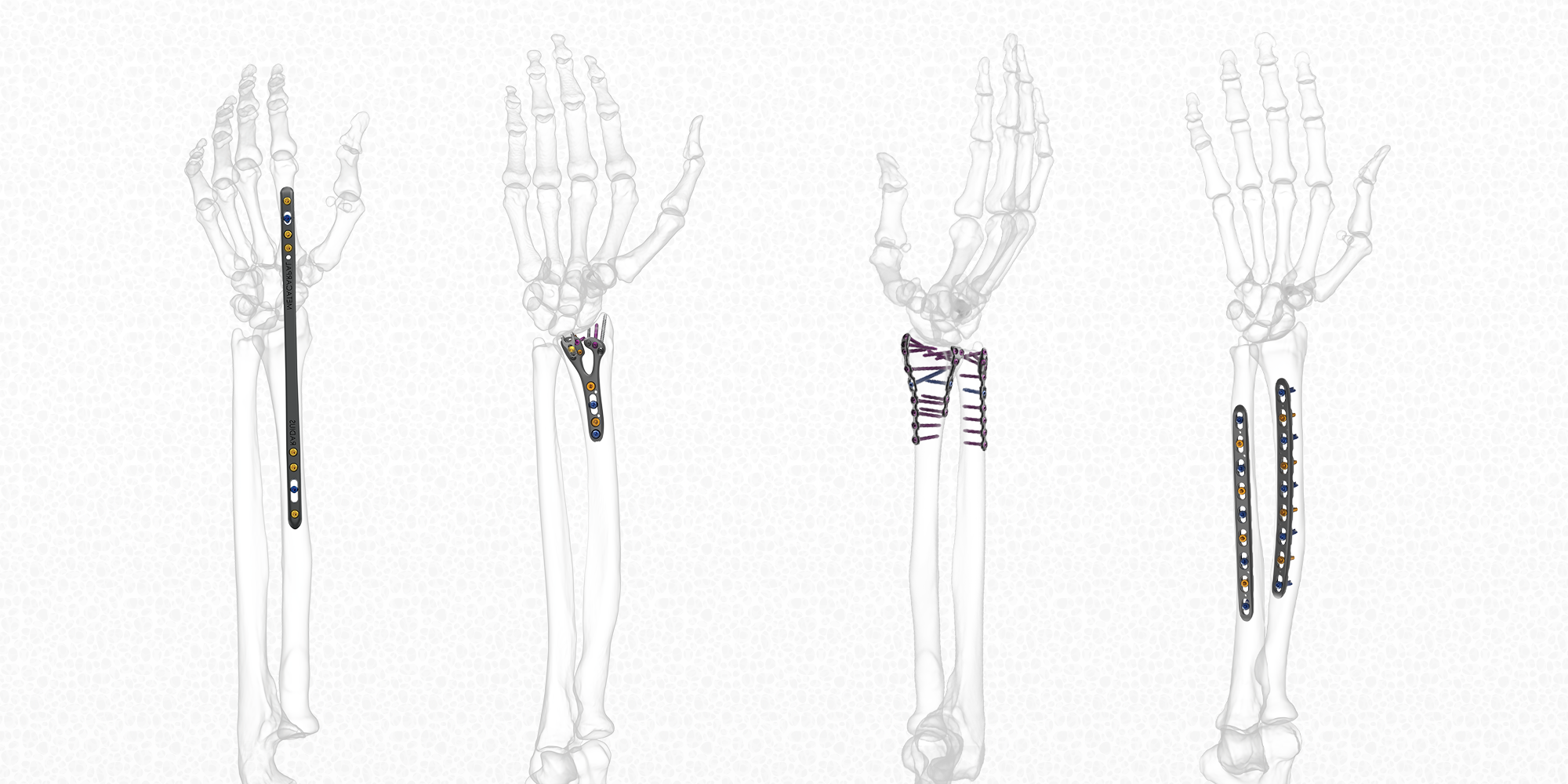 WRIST & FOREARM SET - Skeletal Dynamics