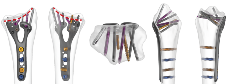 Geminus Distal Radius Plate Skeletal Dynamics