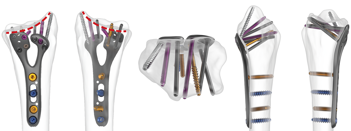 GEMINUS® Distal Radius Plate - Skeletal Dynamics