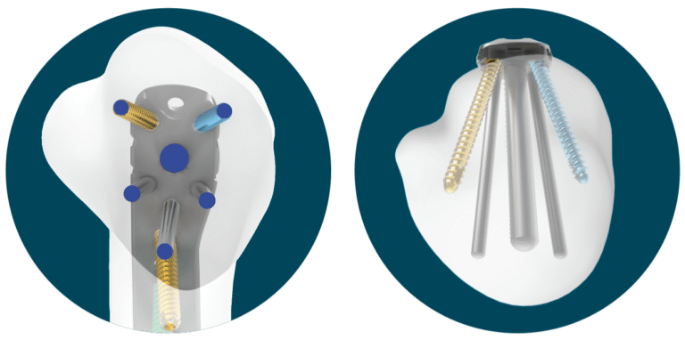 Proximal Humerus Fixation System - Skeletal Dynamics
